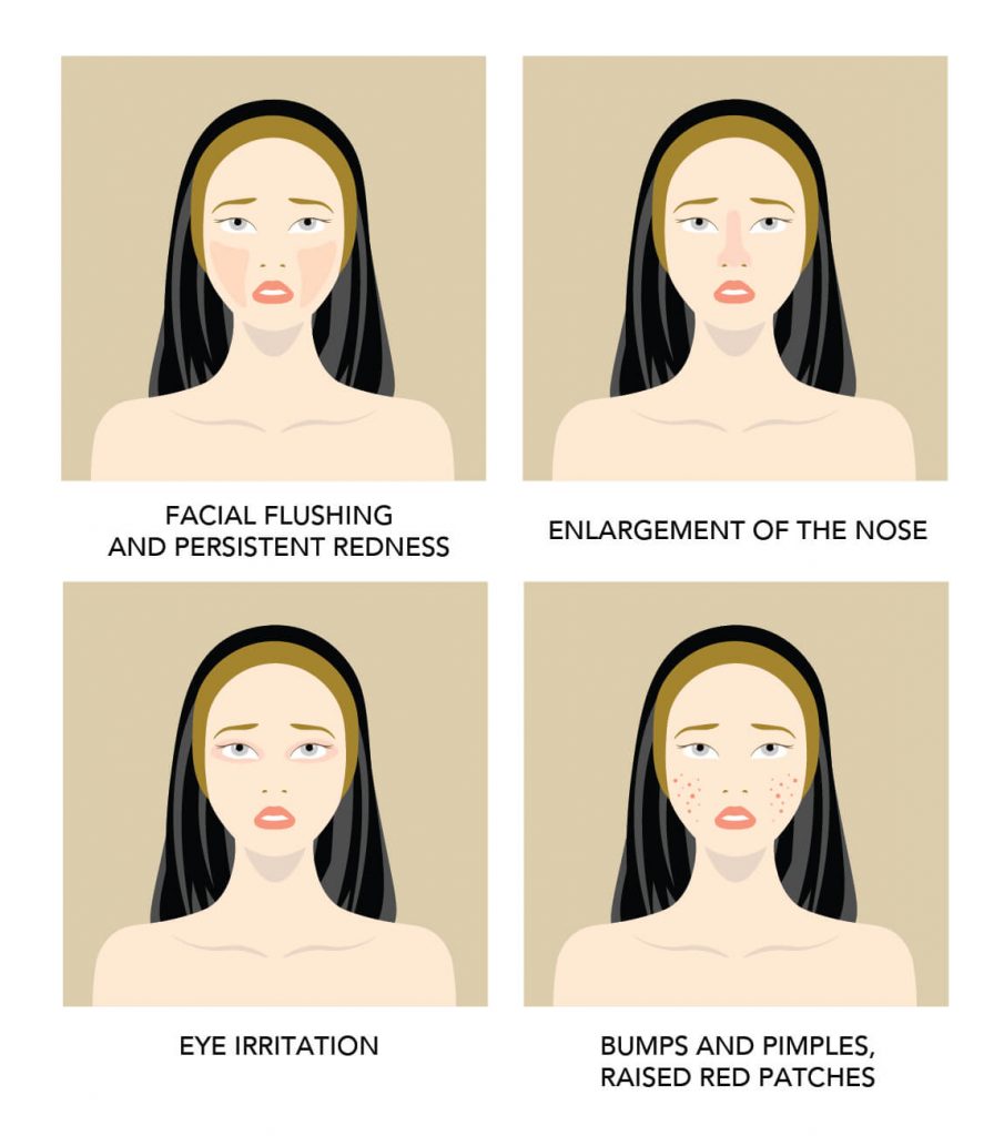 Your Guide to Rosacea - Mild, Moderate and Severe - ORO GOLD School